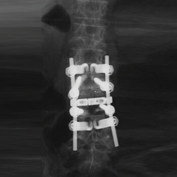 What is Lumbar Spinal Fusion? | Premia Spine