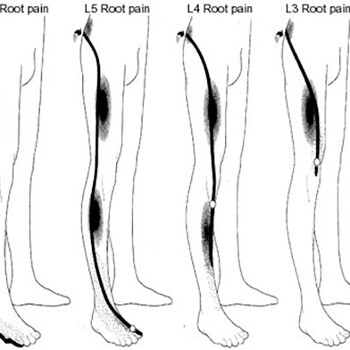 What is sciatica? - Premia Spine