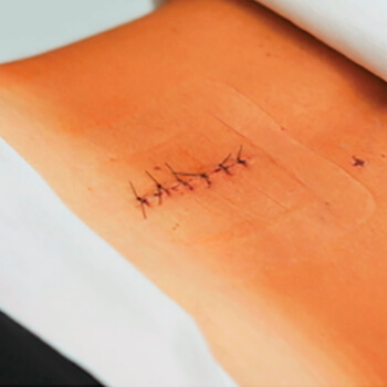 How to Care for Your Spinal Surgery Incision?