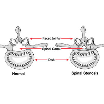 What is Lumbar Spinal Decompression? - Premia Spine
