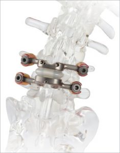 TOPS™ System | Spine Surgery Implant as an Alternative to Spinal Fusion