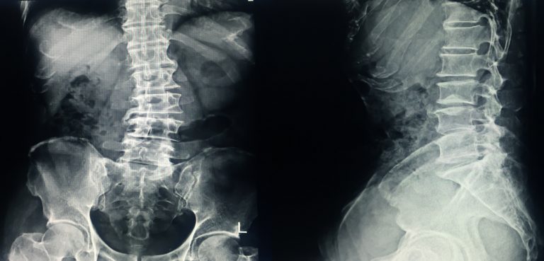 How Scoliosis Affects Life for Elderly People?