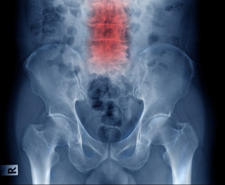 Grade 1 Spondylolisthesis: Causes, Treatments, Recovery