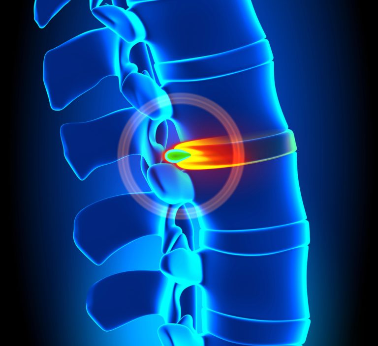 Signs a Herniated Disc Is Healing | Premia Spine Blog