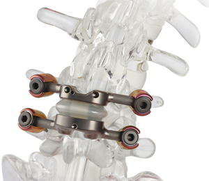 TOPS™ System | Spine Surgery Implant as an Alternative to Spinal Fusion
