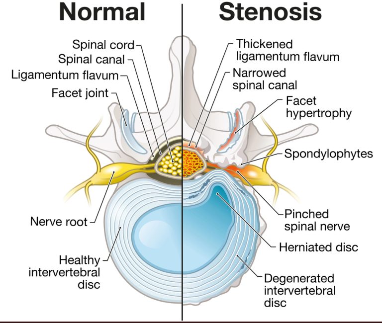 Signs Spinal Stenosis Is Getting Worse - Premia Spine