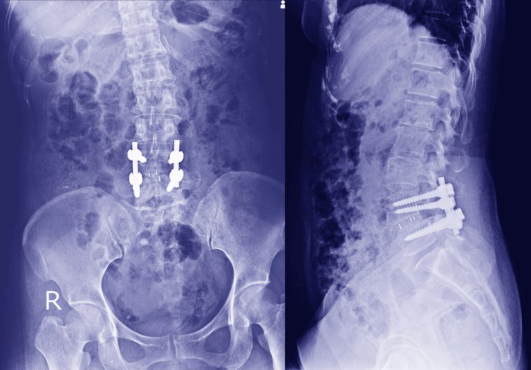 Lumbar Fusion Recovery Week by Week - Premia Spine